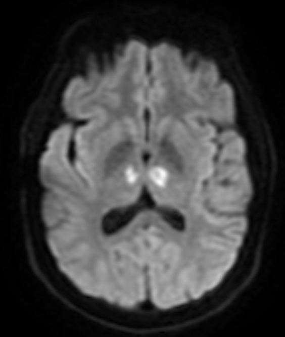 The Percheron – Raven Neurology Review