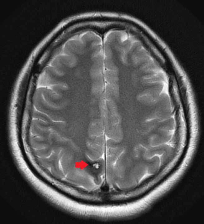 Cavernomas – What Are They? – Raven Neurology Review