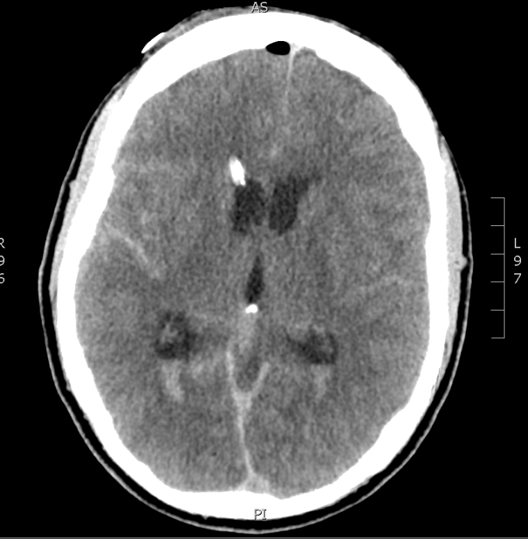 Tips on Evaluating a Head CT – Raven Neurology Review