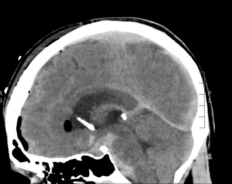 Tips on Evaluating a Head CT – Raven Neurology Review