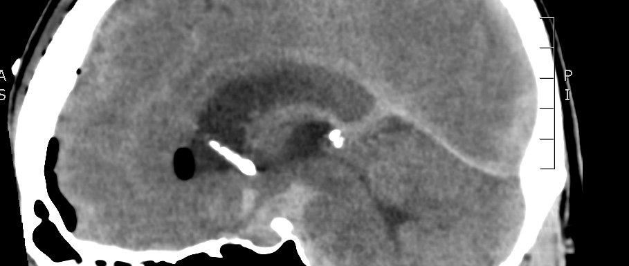 Tips on Evaluating a Head CT – Raven Neurology Review