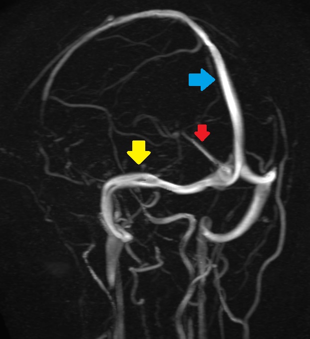 What is ‘Time of Flight?’ – Raven Neurology Review