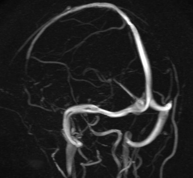 Intracranial hypertension – Raven Neurology Review