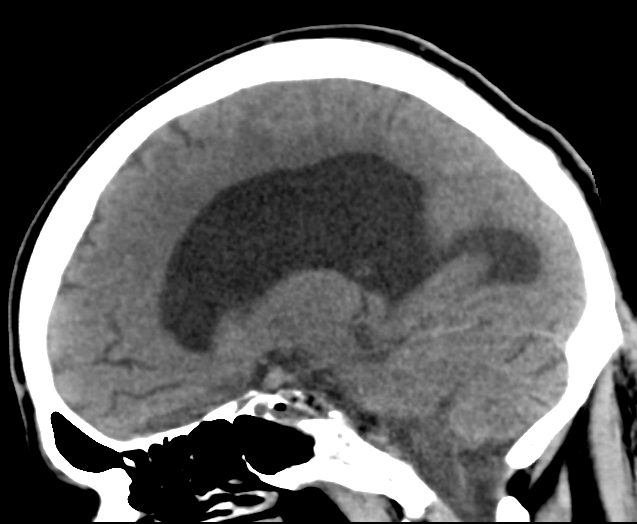 What is Normal Pressure Hydrocephalus? – Raven Neurology Review
