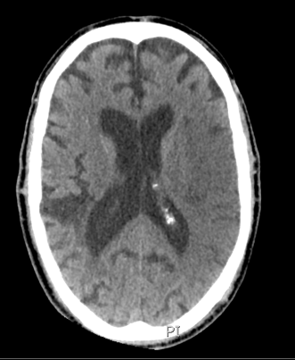 Imaging Basics – CT in Ischemic Stroke – Raven Neurology Review
