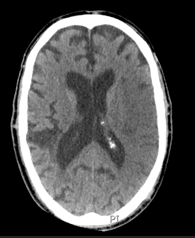 Imaging Basics – CT in Ischemic Stroke – Raven Neurology Review
