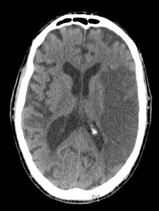 Imaging Basics – CT in Ischemic Stroke – Raven Neurology Review