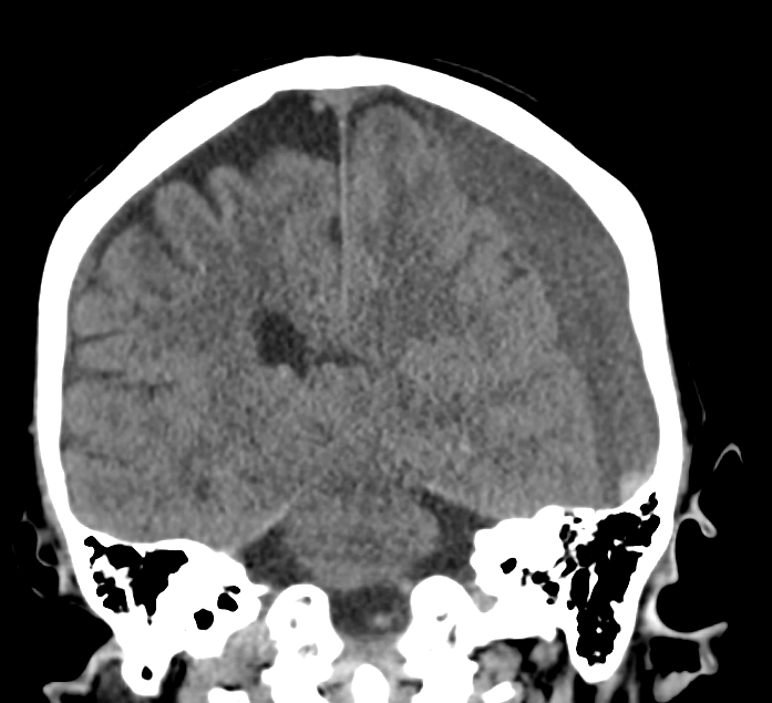 How to Identify a Subdural Hematoma – Raven Neurology Review