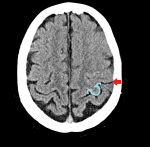 The Omega Sign – Raven Neurology Review