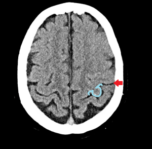 The Omega Sign – Raven Neurology Review