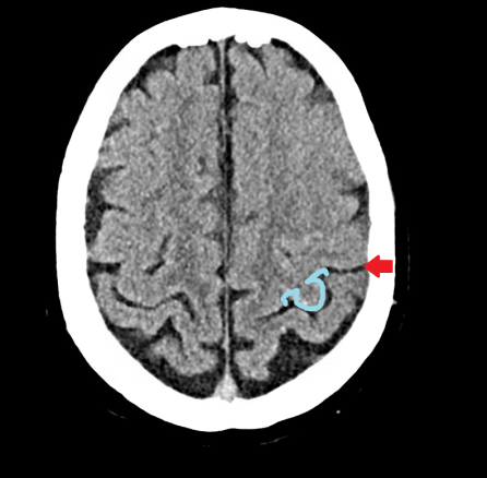 The Omega Sign – Raven Neurology Review