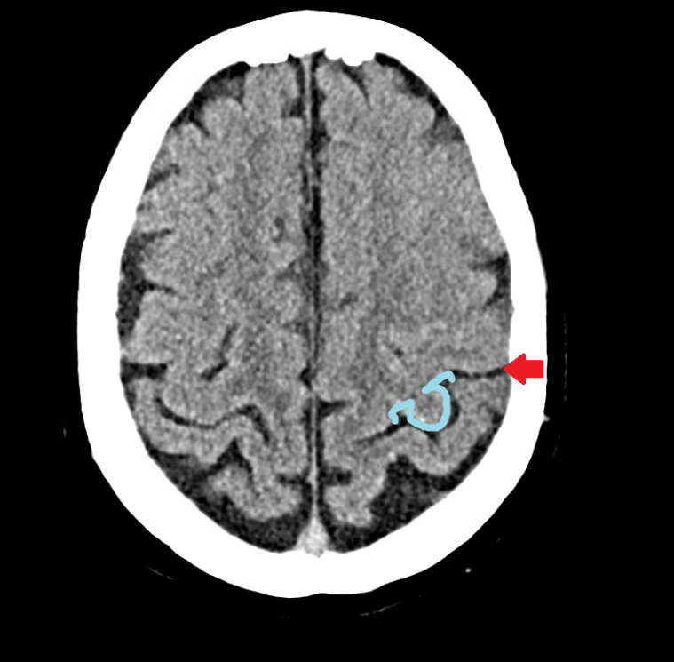 The Omega Sign – Raven Neurology Review