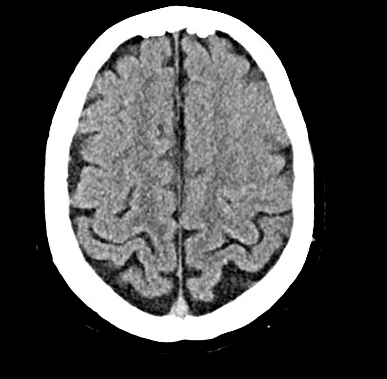 The Omega Sign – Raven Neurology Review