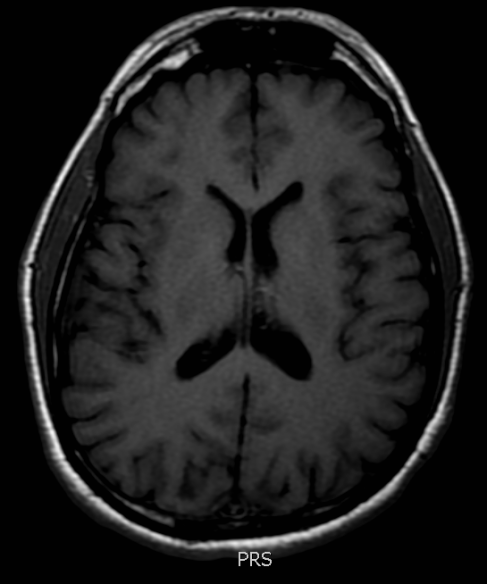 MRI: Tea, Too? – Raven Neurology Review