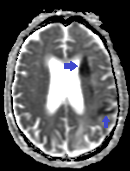 Diffusion Imaging – Raven Neurology Review