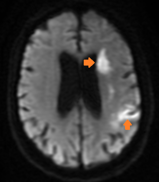 Diffusion Imaging – Raven Neurology Review