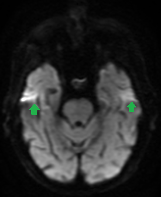 Diffusion Imaging – Raven Neurology Review