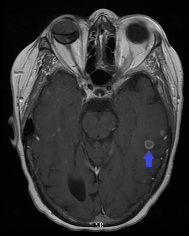 Ring Enhancing Lesions – Raven Neurology Review