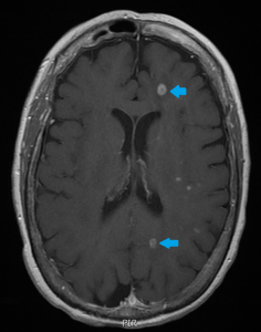 Ring Enhancing Lesions – Raven Neurology Review