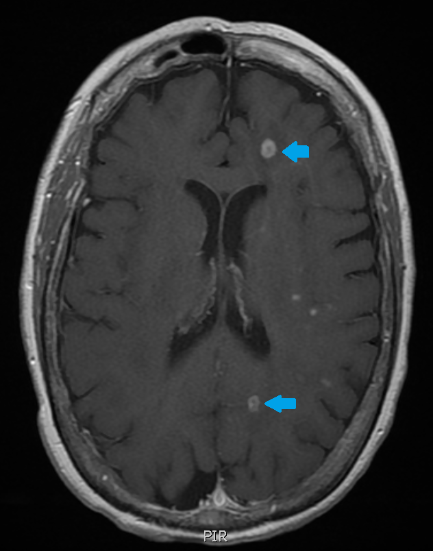 Ring Enhancing Lesions – Raven Neurology Review