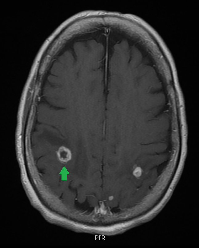 Ring Enhancing Lesions – Raven Neurology Review