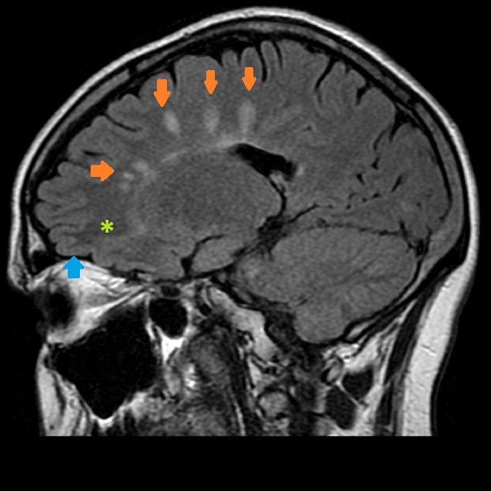 Classic Lesions in MS – Raven Neurology Review
