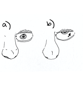 Bell’s Phenomenon – Raven Neurology Review