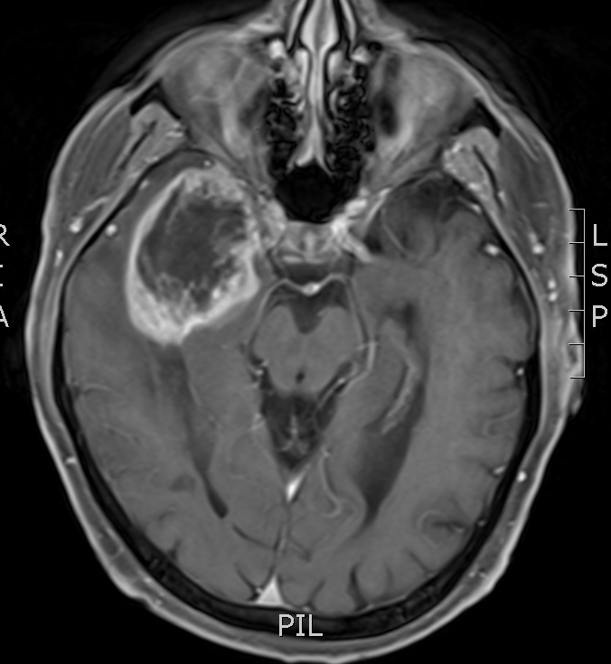 Glioblastoma – Raven Neurology Review