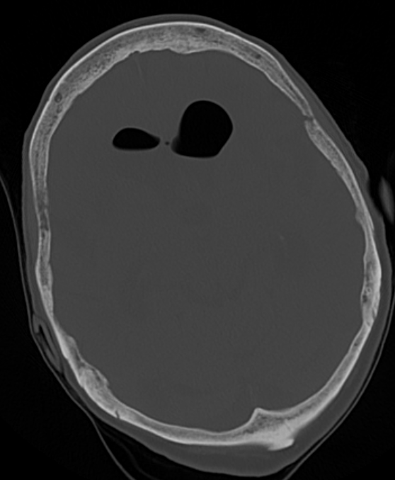 Air in the Brain – Raven Neurology Review
