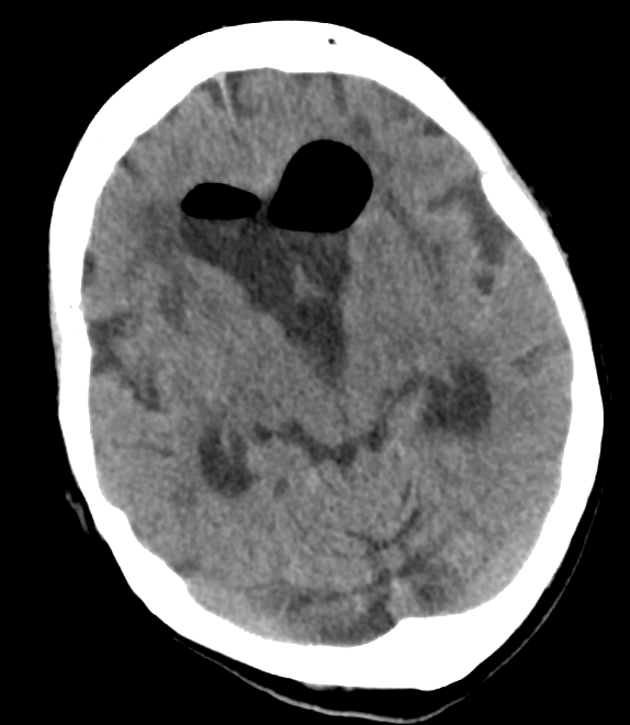 Air in the Brain – Raven Neurology Review