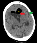 Air in the Brain – Raven Neurology Review
